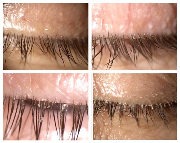 ¿Blefaritis por DEMODEX? Todo lo que necesitas saber